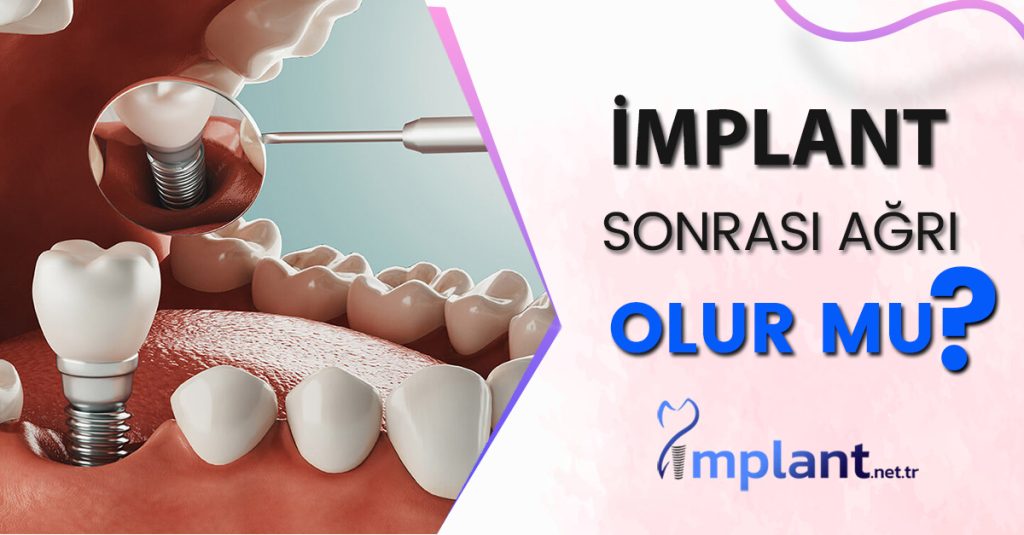 İmplant Sonrası Ağrı Olur mu? - implant.net.tr