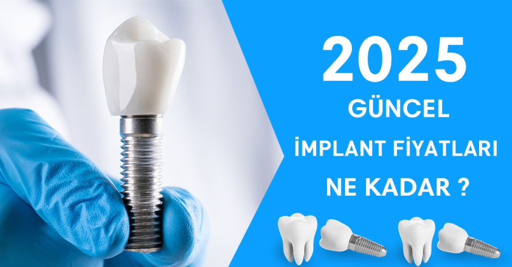 En İyi Dental İmplant Markaları: Hangisini Seçmeliyiz?