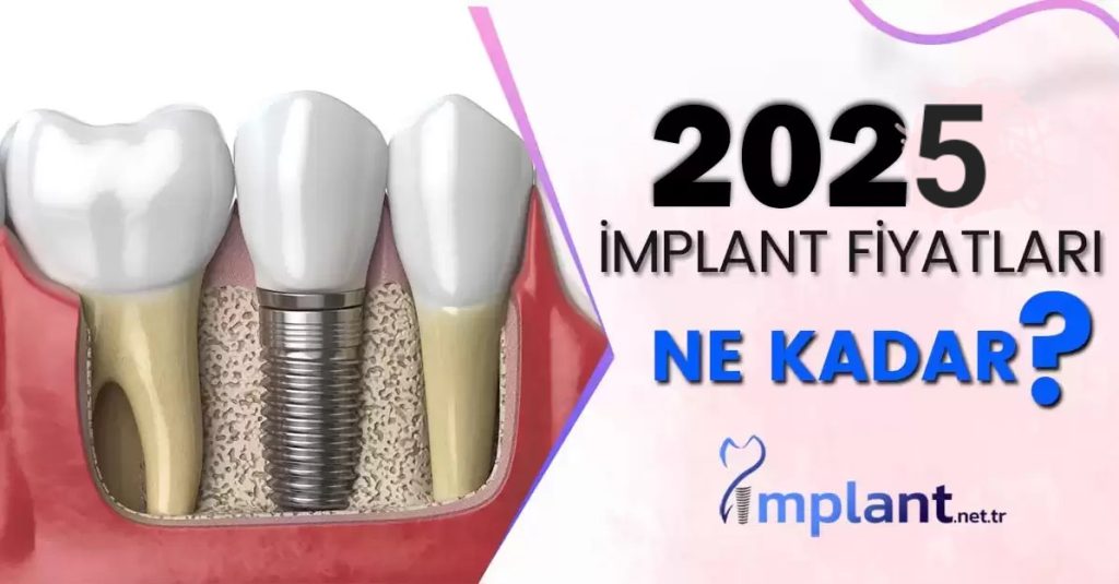 İmplant Fiyatları 2025 -İSTANBUL - implant.net.tr